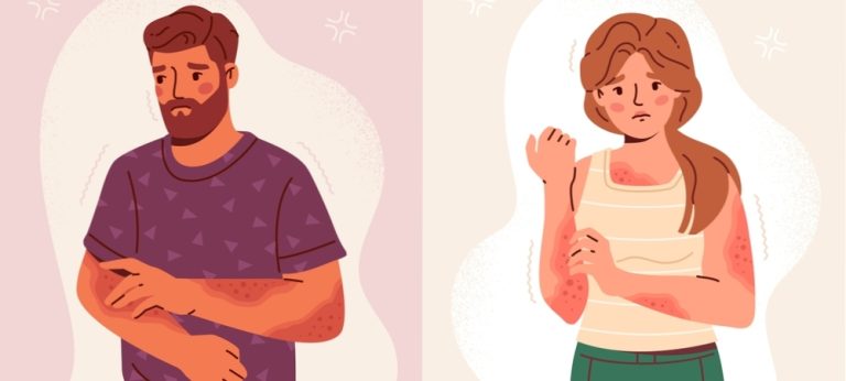 Papular Eczema is more than Just an Itch: A Complete Guide