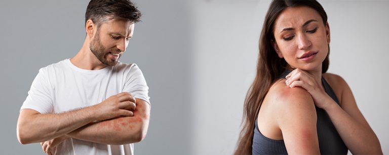 Eczema Vs. Hives: Symptoms, Causes, & What's the Difference?