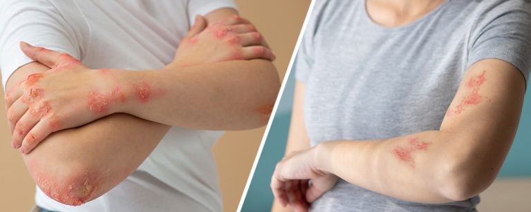 Psoriasis Vs Shingles: Learn The Signs And Causes