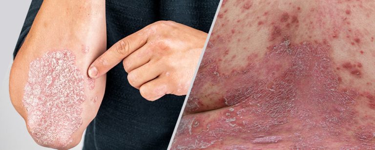Psoriasis Vs Shingles: Learn The Signs And Causes