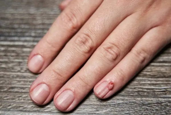 Healthcare Blogs | Dermatology | MetroBoston Clinical Partners