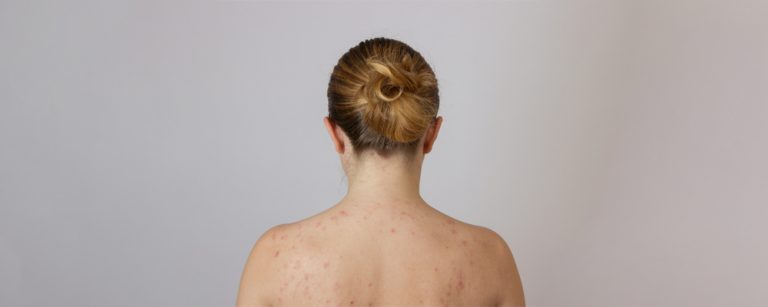 Shoulder Acne: Types, Causes, Symptoms & Treatment Options