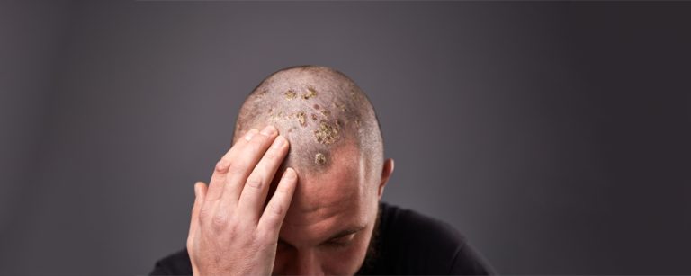 Scalp Eczema Symptoms Causes And How To Treat It