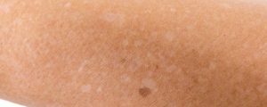 White Sun Spots on Skin - Possible Causes and Treatment