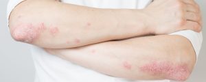 Psoriasis on Elbow: Symptoms, Causes and Treatment Options