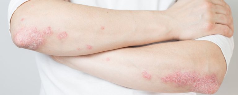 Psoriasis on Elbow: Symptoms, Causes and Treatment Options