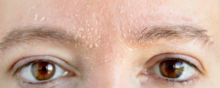 Facial Psoriasis: Skincare, Treatment & Prevention Tips