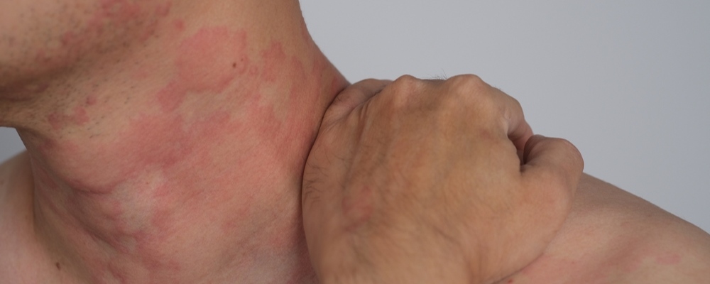 Cholinergic Urticaria: The Hives from Heat or Sweat