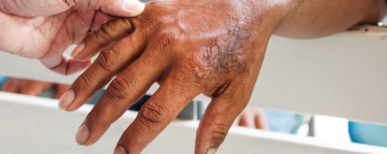 What Is Dermatitis Neglecta? A Poor Hygiene Skin Condition