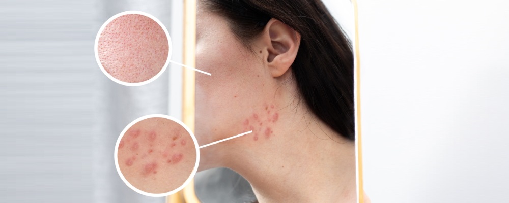 Jawline Acne: Why It Happens and How to Get Rid of It