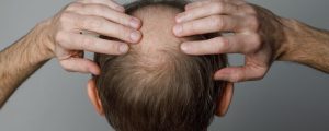 Scarring Alopecia: Everything You Need to Know