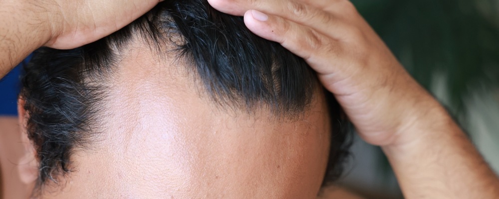 Scalp Cellulitis Symptoms
