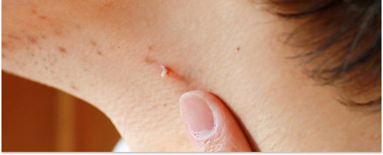 Filiform Warts: Causes, Risks & Treatment Options