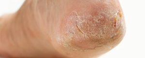 Psoriasis on Feet: Guide to Symptoms, Causes, and Treatments