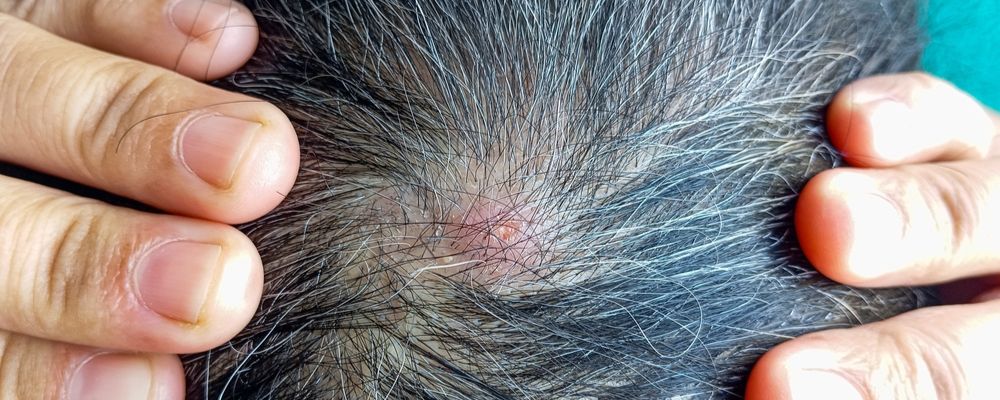 Why You Get Acne on Scalp - Causes and Treatment.