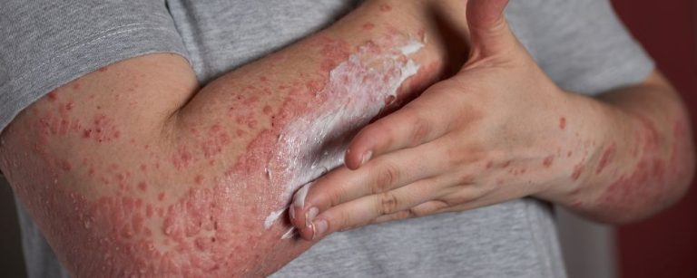 Pustular Psoriasis: Causes, Symptoms, Signs & Treatment Options.