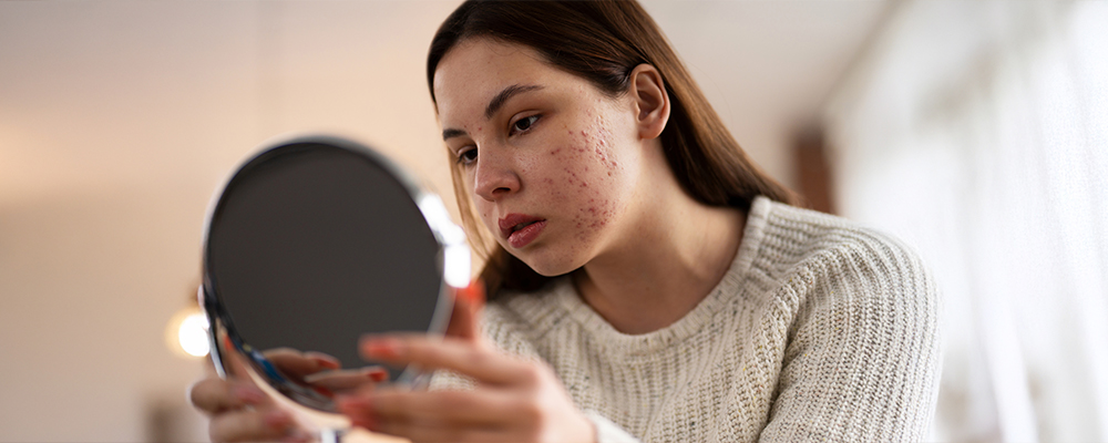 Nodular Acne: What It Looks Like, Causes & Treatment